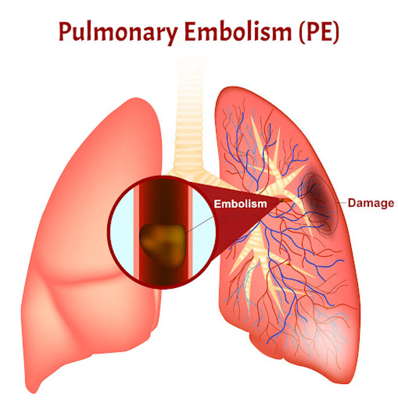 Pulmonary Embolism pulmonary-embolism